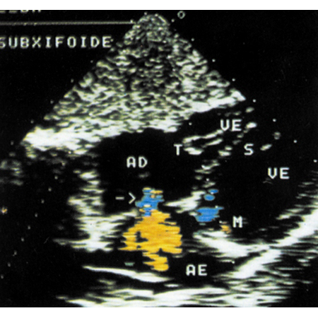 II - Cardiopatias Congênitas com Shunt E>D para Ecocardiografistas de ...